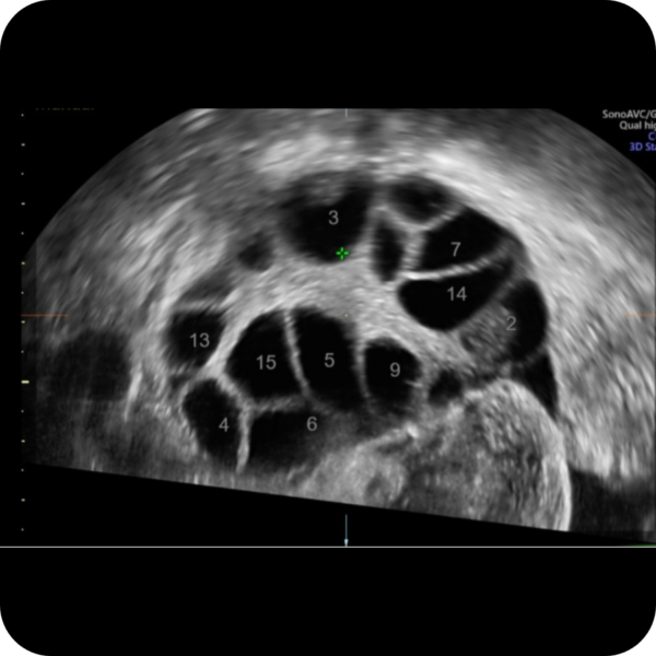 Follicle Tracking | HerView Ultrasound – Herview Ultrasound