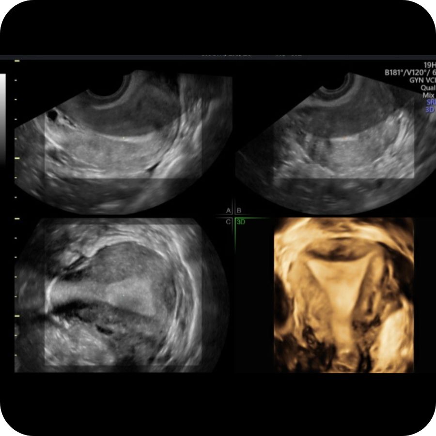 Herview Ultrasound